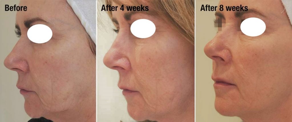 Prophilo Skin Boosters